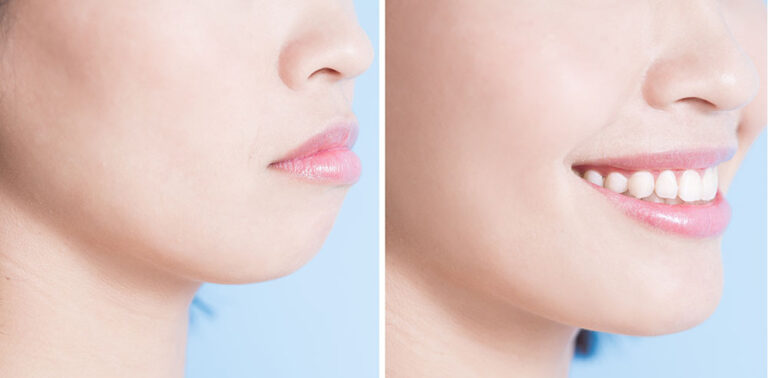 Recessed Chin via Sliding Genioplasty - Clinic Search Korea