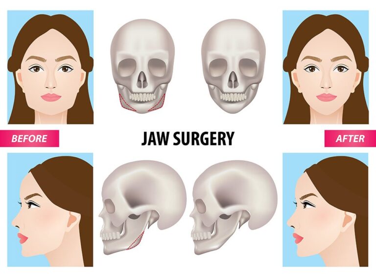 Square Jaw Reduction - Clinic Search Korea